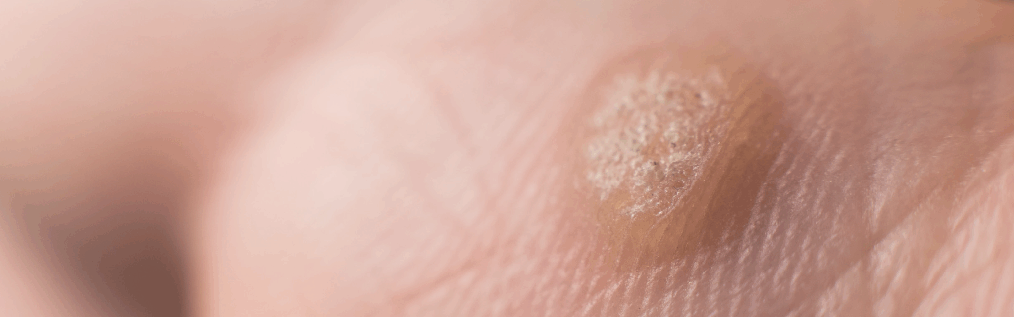 Wart & Verruca Removal in Armagh – Safe Cryotherapy